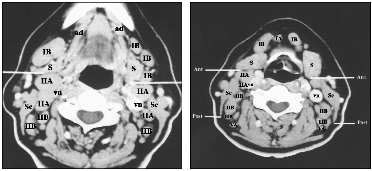Cervical Lymph Nodes Stations